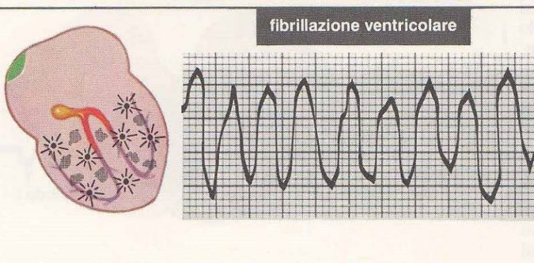 Fibrillazione ventricolare | Blog sulla Salute del Cuore